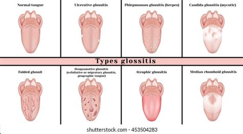Glossitis Causes Glossitis Types And Glossitis Treatment 50 OFF