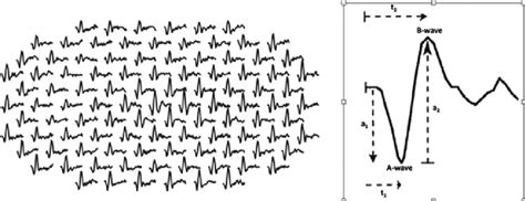 The Multifocal Electroretinogram Mferg Technique Allows Local Erg