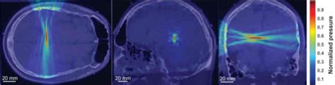 Transcranial Focused Ultrasound Stimulation Of Human 42 Off