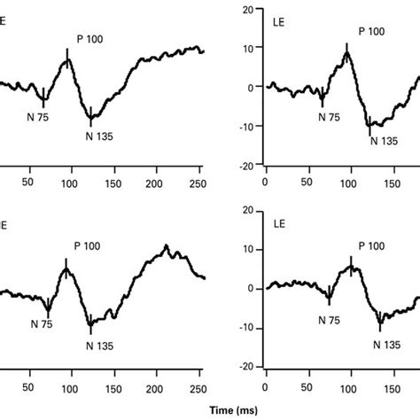 Transient Pattern Reversal Visually Evoked Potentials Of The Right And Download Scientific