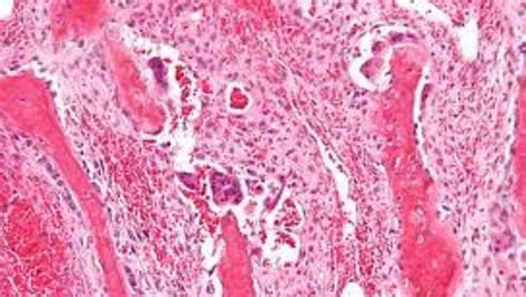 Hypercalcemia Medical Centric