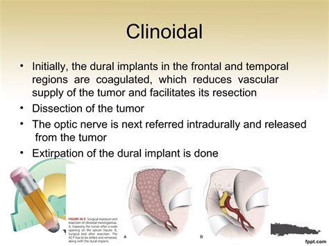 Sch36 Surgical Management Of Sphenoid Wing Meningioma Ppt