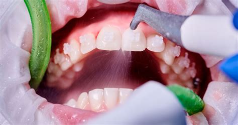 Qué es una profilaxis dental y por qué es tan importante