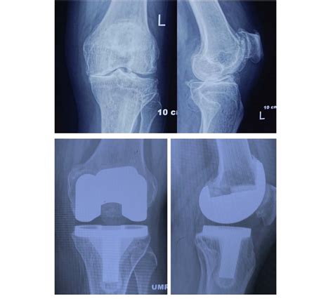Pre And Post Operative Radiographs Of Tka Pfc Sigma Ps For Medial Oa