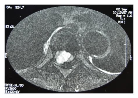 Preoperative Axial A And Sagittal B T1 Weighted And Sagittal C