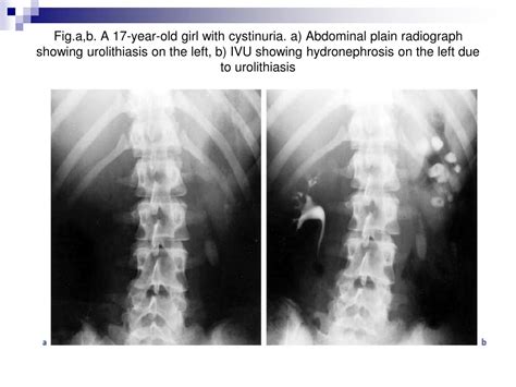 Ppt Urolithiasis Syndrome Of Swollen Scrotum Powerpoint