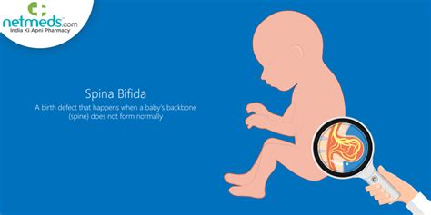 Spina Bifida Types