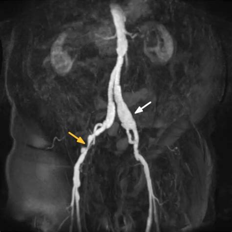 Mr Angiography Angio Mri Radiology Network Aristra