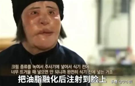 痴迷整容的代价：韩美玉自行注射食用油，摘除手术令医生傻眼了想法日本发展