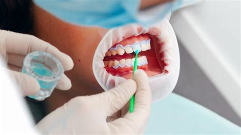 The Ultimate Guide To Teeth Whitening Strips Powder Gel Toothpaste