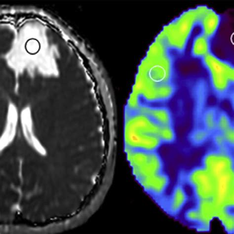 Demonstration Of Additional Imaging Left Adc Map Right Asl Circles Download Scientific