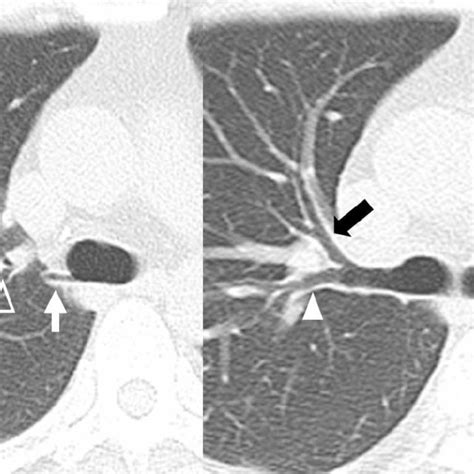 Tracheal Bronchus Right Upper Lobe Bronchus From Tracheal Bifurcation
