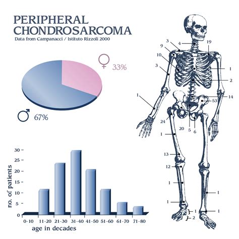 Peripheral Chondrosarcoma