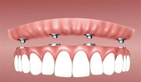 Proteza na implantach inwestycja w piękny uśmiech DERM pl