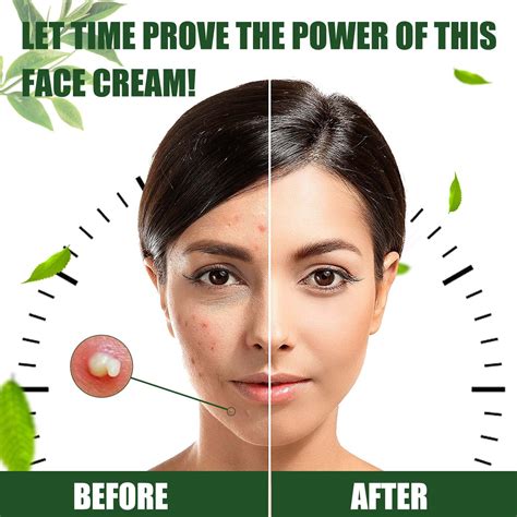 Yoomi 3 Pack Acid 15 Acne Cream Redness Relief Rosacea Treatment