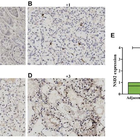 NSD2 Is Over Expressed In CcRCC Tissues By Immunohistochemistry IHC