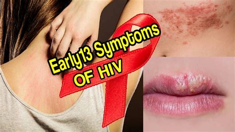 Symptoms Of Hiv In Men Mouth