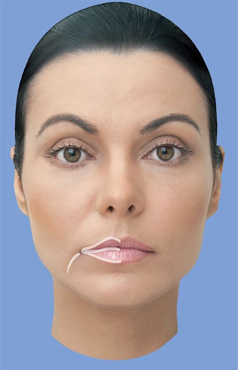 Chapter 16 Filler Injection Of The Lips Oral Commissure And