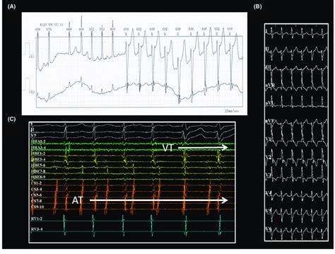 A A 24 Hour Holter Ecg Recording Almost All Of His Tachycardia Download Scientific Diagram