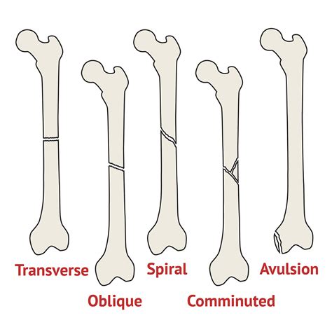 Types Of Bone Fracture Rightconcepts