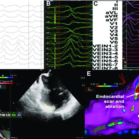 Electrocardiogram Ecg Pace Map And Electroanatomic Mapping Eam Download Scientific