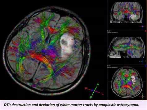 Presentation1pptx Diffusion Tensor Imaging Of White Matter Tract In