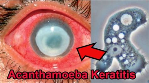 Bloke Goes Blind In One Eye From Showering With Contact Lenses In