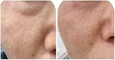 Tiêm meso Exosome có tốt không Giá báo nhiêu