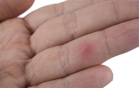 The Best Way To Remove A Splinter Mens Health