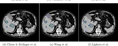 Pdf The Liver Tumor Segmentation Benchmark Lits Semantic Scholar