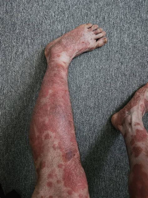First Treatment Of Bimzelx Vs My Psoriasis After Only 3 Weeks Its