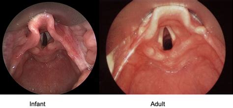 Neonatal Airway Anatomy Laryngomalacia 1176