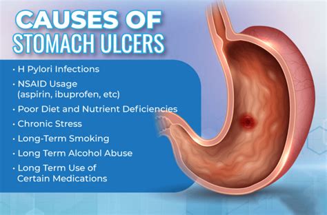 Stomach Ulcer Causes Symptoms And Treatment Forever Champion Health