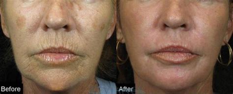 Co2 Fractional Laser Before And After Photo Gallery Portland Or