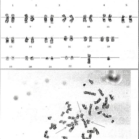 Male Karyotype With Trisomy 18 47xy18 Download Scientific Diagram