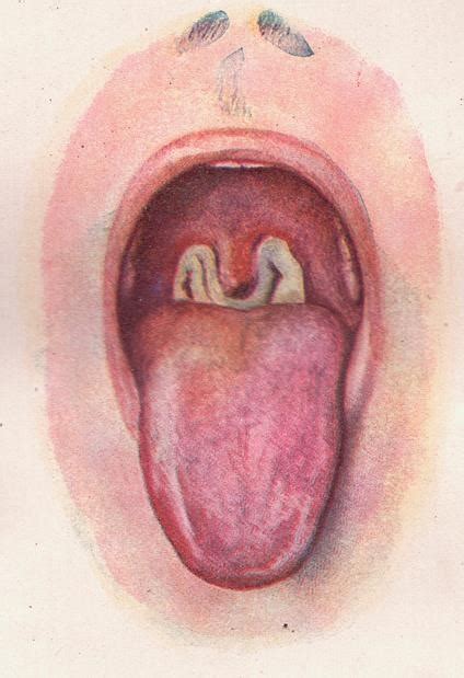 Difteria Síntomas Causas Y Tratamiento