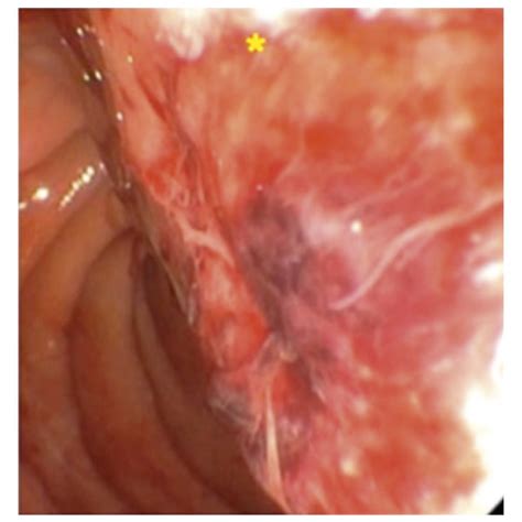 A B Endoscopy Ulcerated Mass ∗ Adjacent To Ampulla Of Vater