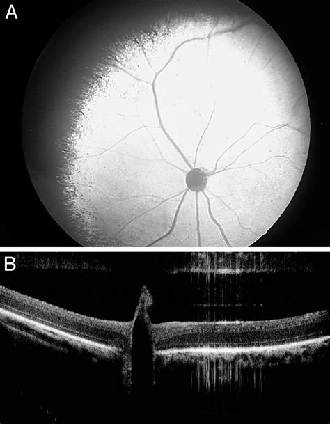 Intraocular Silicone Ball Implantation After Evisceration In A Slow