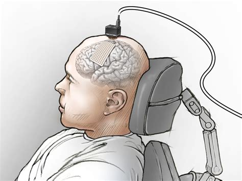 Kuow Experimental Brain Implant Lets Man With Paralysis Turn His