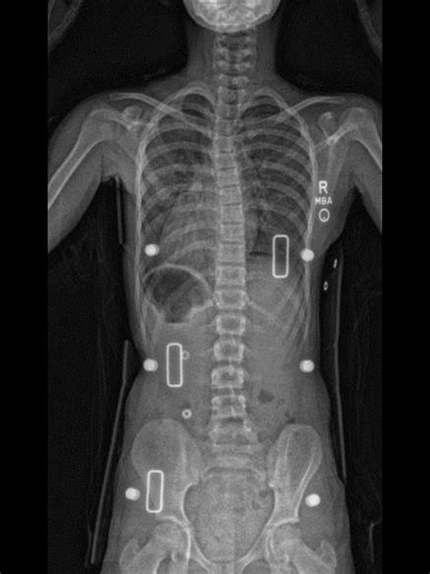 Spinal Tech Full Time Scoliosis Brace