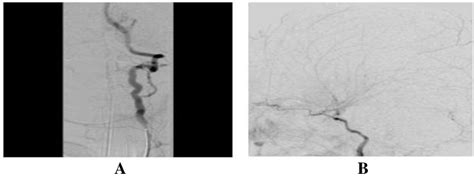 A And B Ir Angio Shows Revealed Bilateral Supraclinoid Ica Occlusion