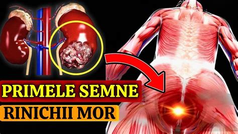 Rinichii Sunt Pe Moarte 10 Semne Stranii CĂ Rinichii TĂi Sunt DeterioraȚi Youtube