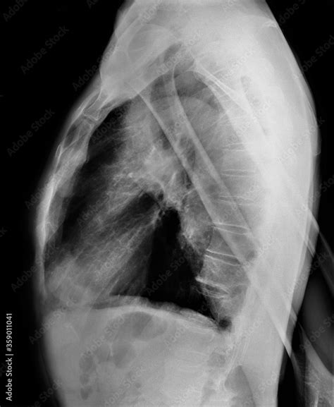 X Ray Of The Human Chest In A Lateral Projection Stock Photo Adobe Stock