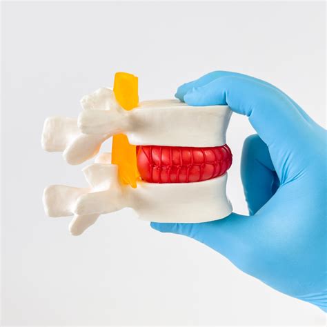 Understanding Herniated Disks Symptoms And Insights