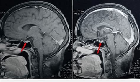 MRI Of The Mid Sagittal Section Of The Brain Showing Partially Empty