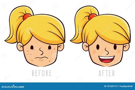 Girl Face With Acne Problem Before And After Stock Vector