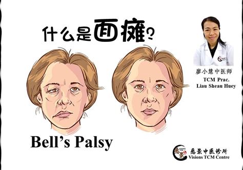 Bells Palsy Archives 愿景中医 Visions Tcm