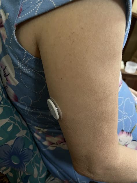 463 Best Freestyle Libre Images On Pholder Freestylelibre Diabetes And Diabetes T1