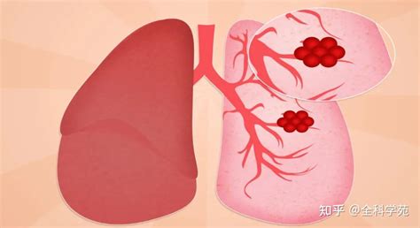 肺癌一查就是晚期?提醒:8种常见表现要知道! 知乎 肺癌一查就是晚期?提醒:8种常见表现要知道! 知乎