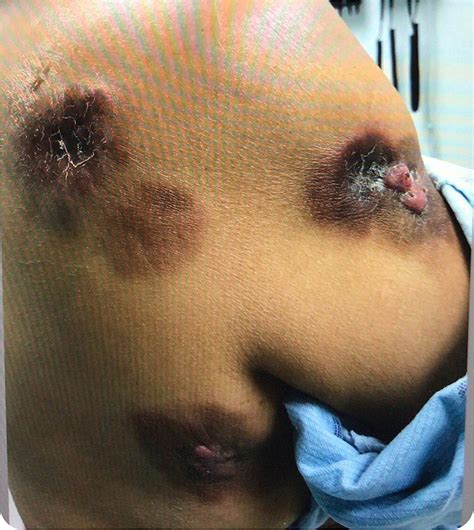 Persistent Pink Nodules And Hyperpigmented Plaques On Trunk And